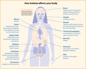 Bulimia Nervosa Treatment Center | Indiana | Selah House